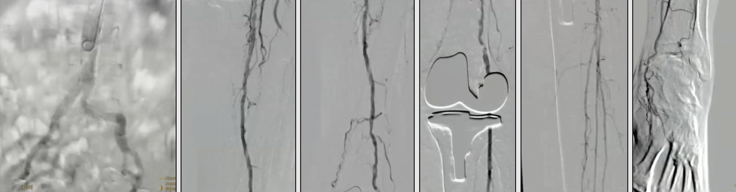 Expanding the Limits of Radial-to-Peripheral Intervention ...