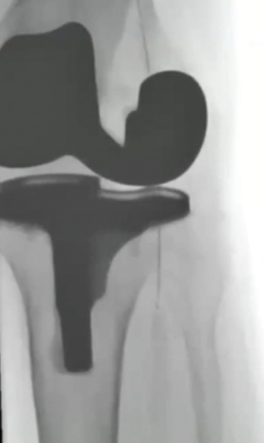 Expanding the Limits of Radial-to-Peripheral Intervention ...