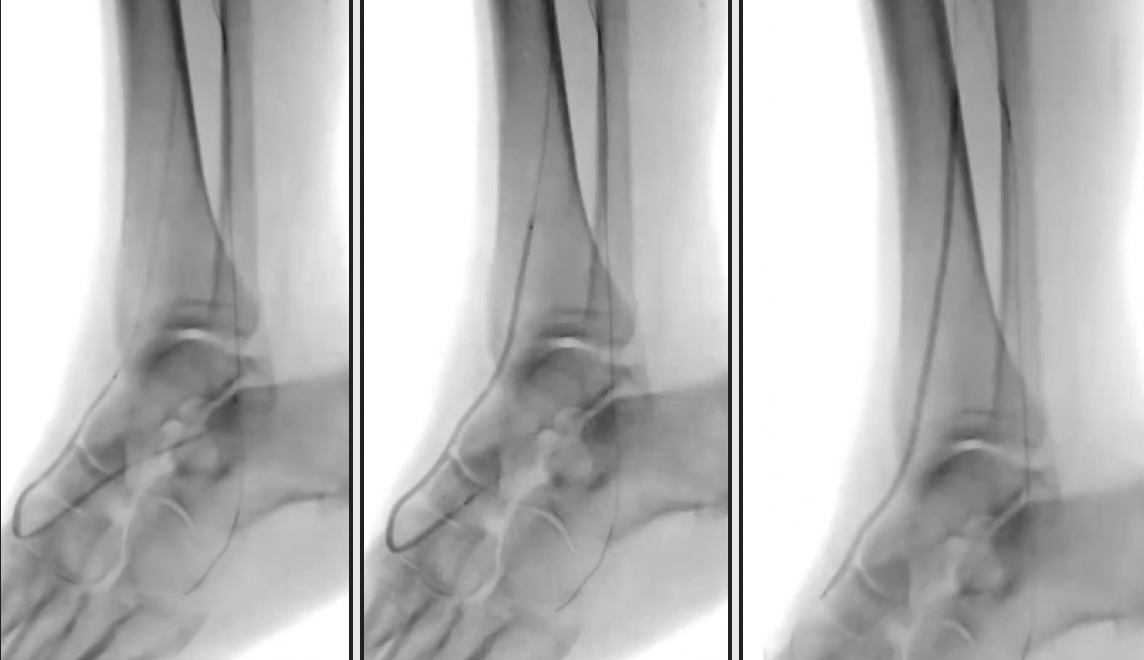Expanding the Limits of Radial-to-Peripheral Intervention ...