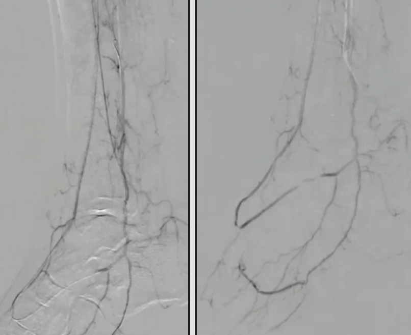 Expanding the Limits of Radial-to-Peripheral Intervention ...