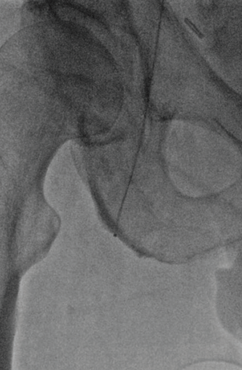 Scaling to 70% Radial-to-Peripheral in a Hospital Setting ...