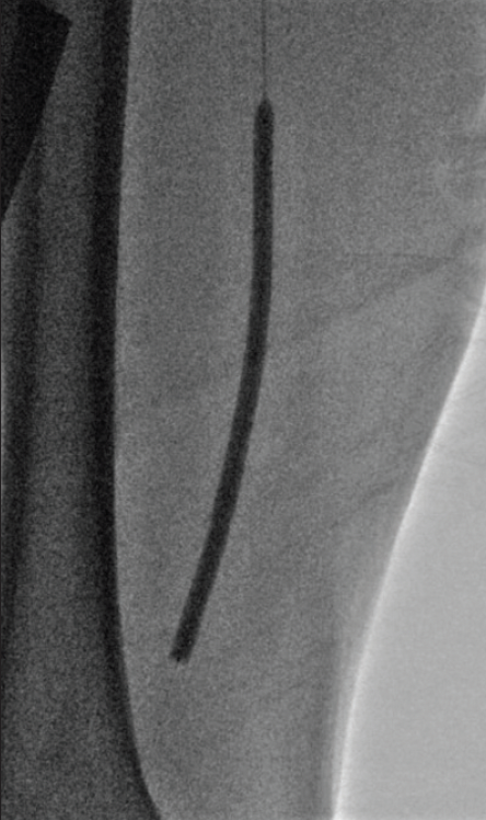 Scaling to 70% Radial-to-Peripheral in a Hospital Setting ...