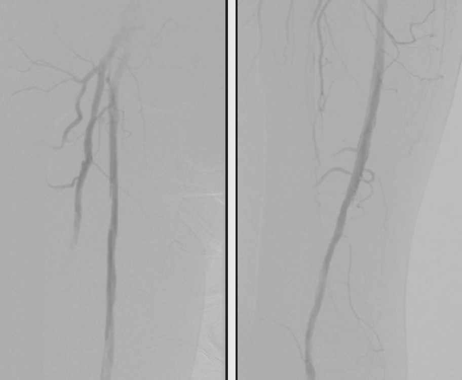 Scaling to 70% Radial-to-Peripheral in a Hospital Setting ...