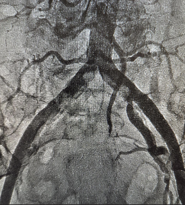 Reducing the Radial-to-Peripheral Gender Gap With 5 Fr Guide Sheaths ...