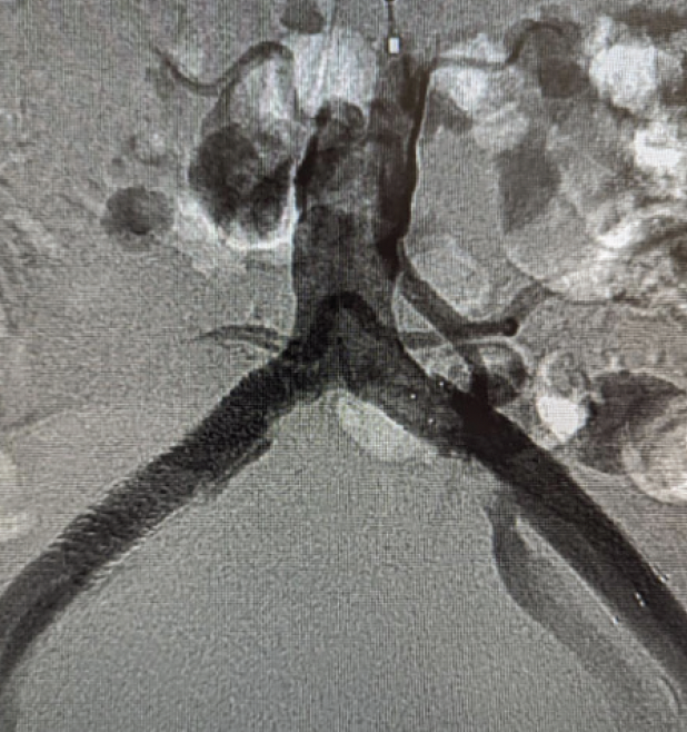 Reducing the Radial-to-Peripheral Gender Gap With 5 Fr Guide Sheaths ...