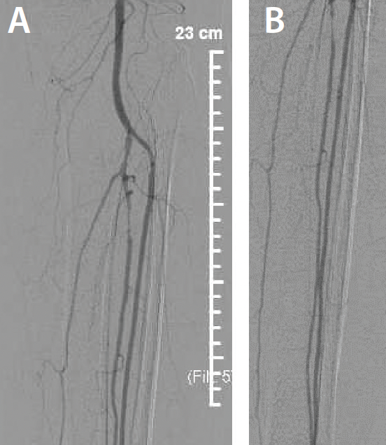 Tackling CLTI From Alternative Access Sites - Endovascular Today