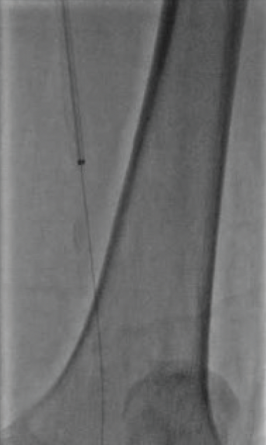 Tackling CLTI From Alternative Access Sites - Endovascular Today