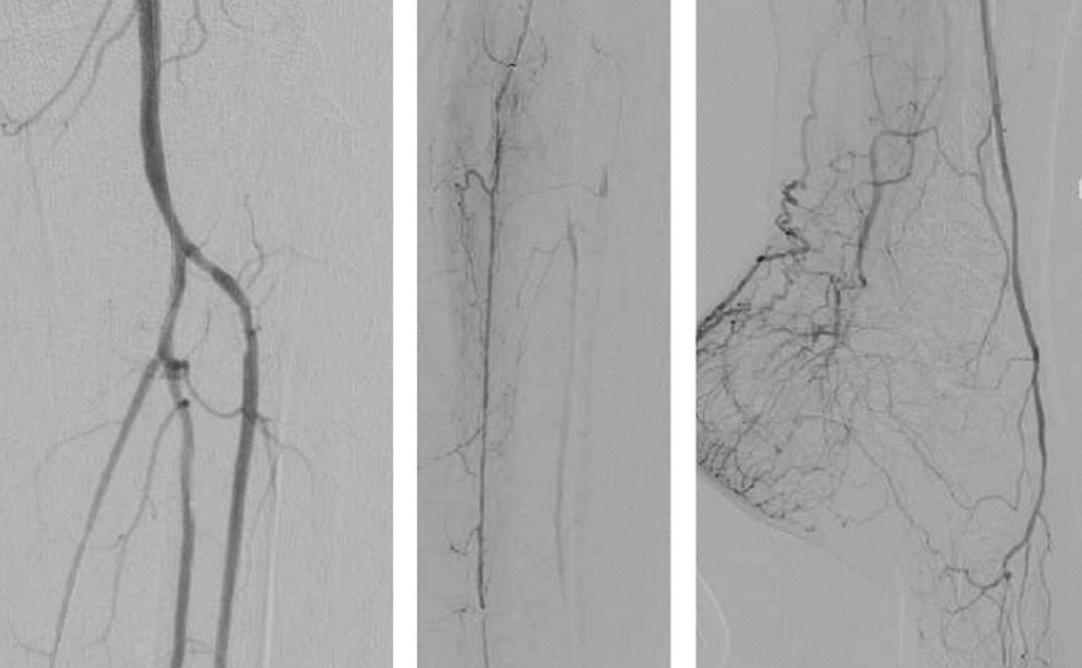 Tackling CLTI From Alternative Access Sites - Endovascular Today