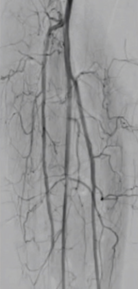 A Meeting of Radial Revolutionaries - Endovascular Today