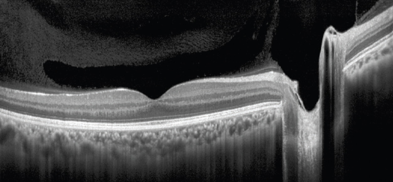 Know Your Vitreomacular Interface Disorders - Modern Optometry