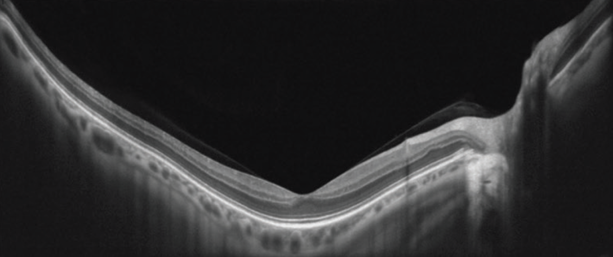 Know Your Vitreomacular Interface Disorders - Modern Optometry