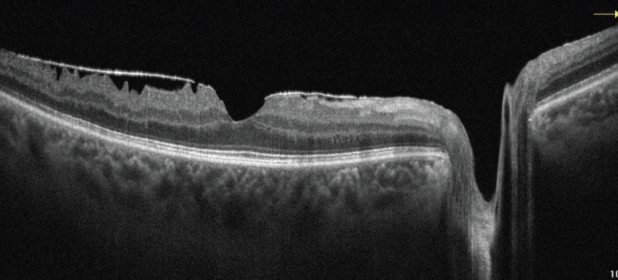 Know Your Vitreomacular Interface Disorders - Modern Optometry