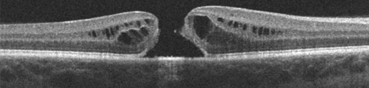Know Your Vitreomacular Interface Disorders - Modern Optometry