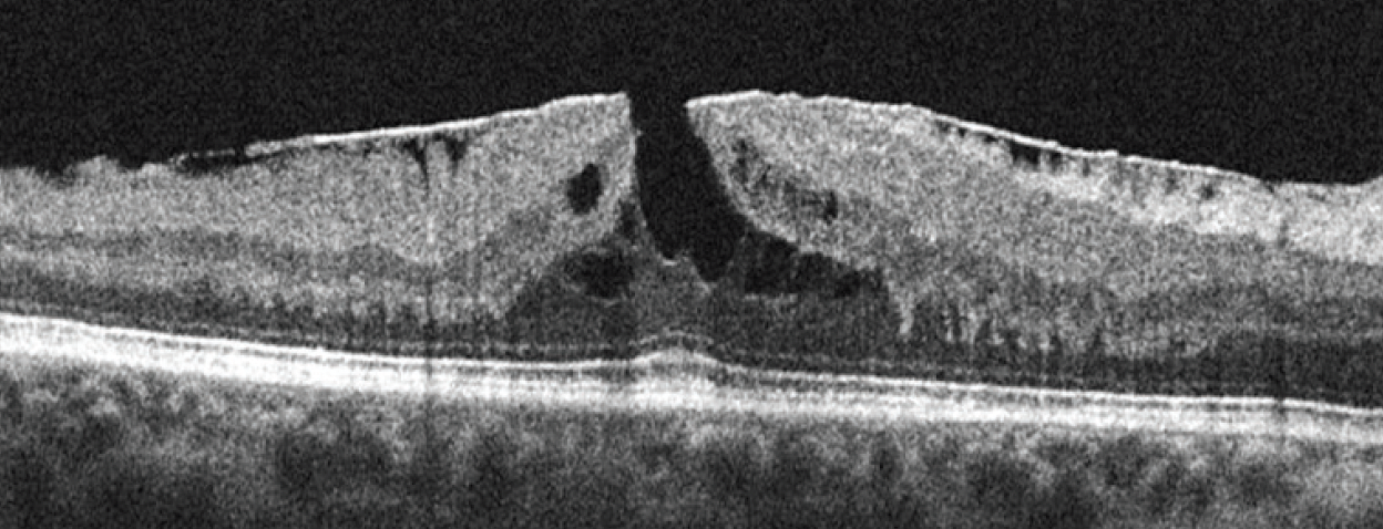 Know Your Vitreomacular Interface Disorders - Modern Optometry