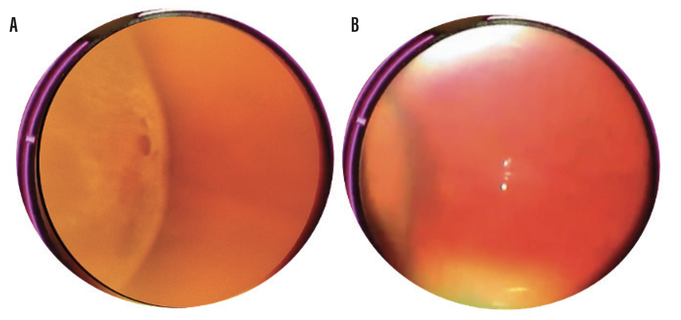 Clinical Tips to Perform Effective Scleral Indentation - Modern Optometry