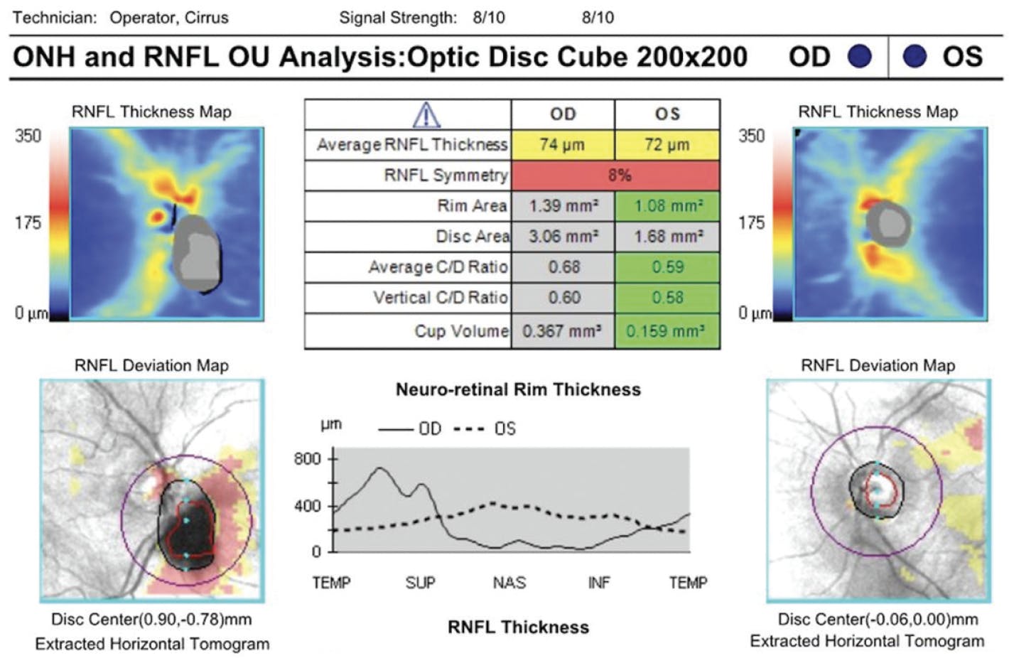 Why It’s Important to Have an OCT in Your Practice - Modern Optometry