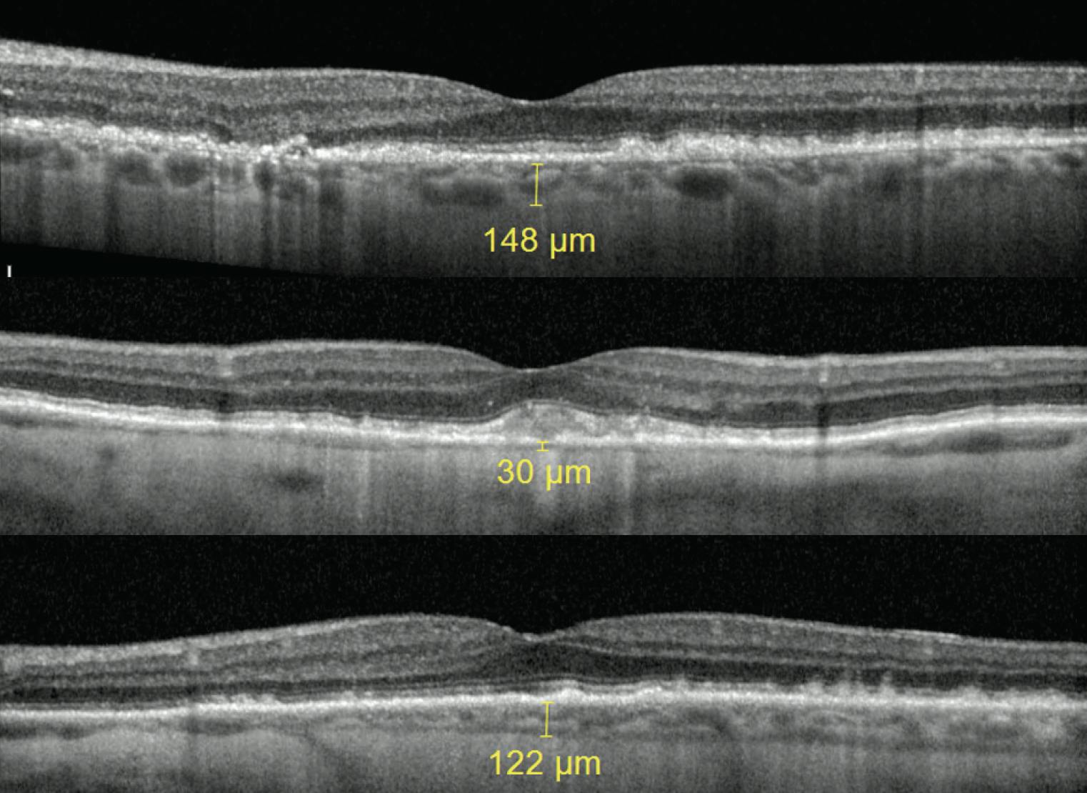 Normal Macula Oct Look Eyecare Opticians | Belfast | OCT Scan
