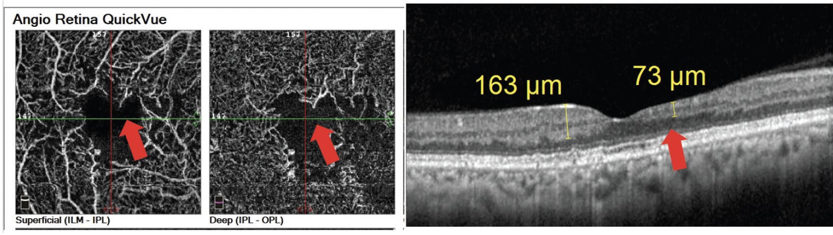Tips for Recognizing and Understanding OCT Biomarkers - Modern Optometry