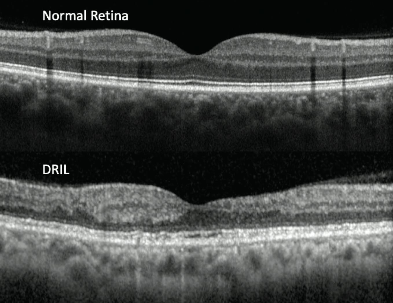 Tips for Recognizing and Understanding OCT Biomarkers - Modern Optometry