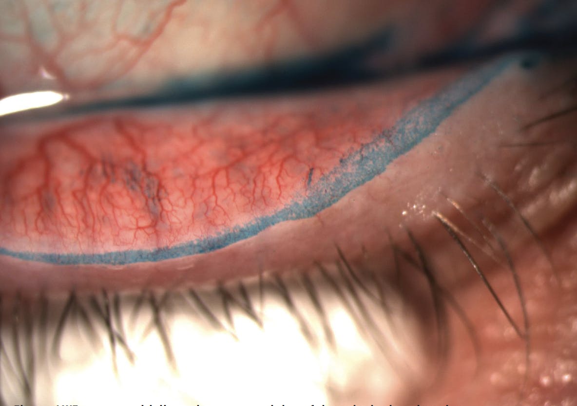 Putting a Lid on Epitheliopathy - Modern Optometry