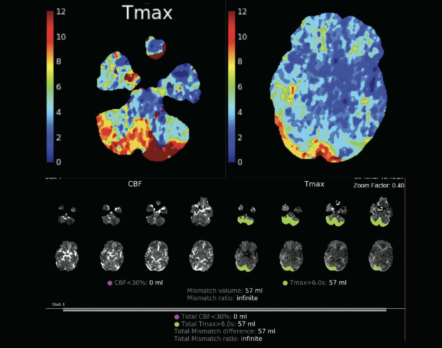 Vertebral Artery Dissection 10 Days Later