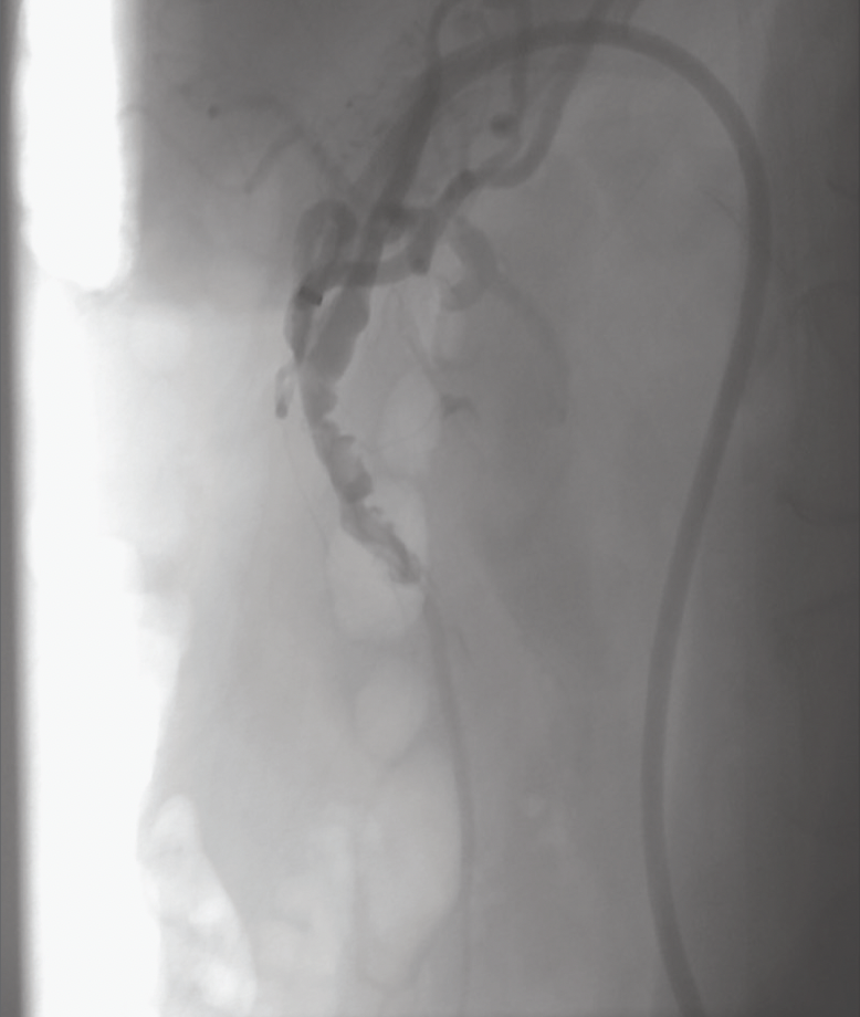 CASE REPORTSuccessful Removal of an SMA Embolus With the Pounce ...
