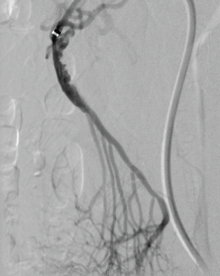 CASE REPORTSuccessful Removal of an SMA Embolus With the Pounce ...