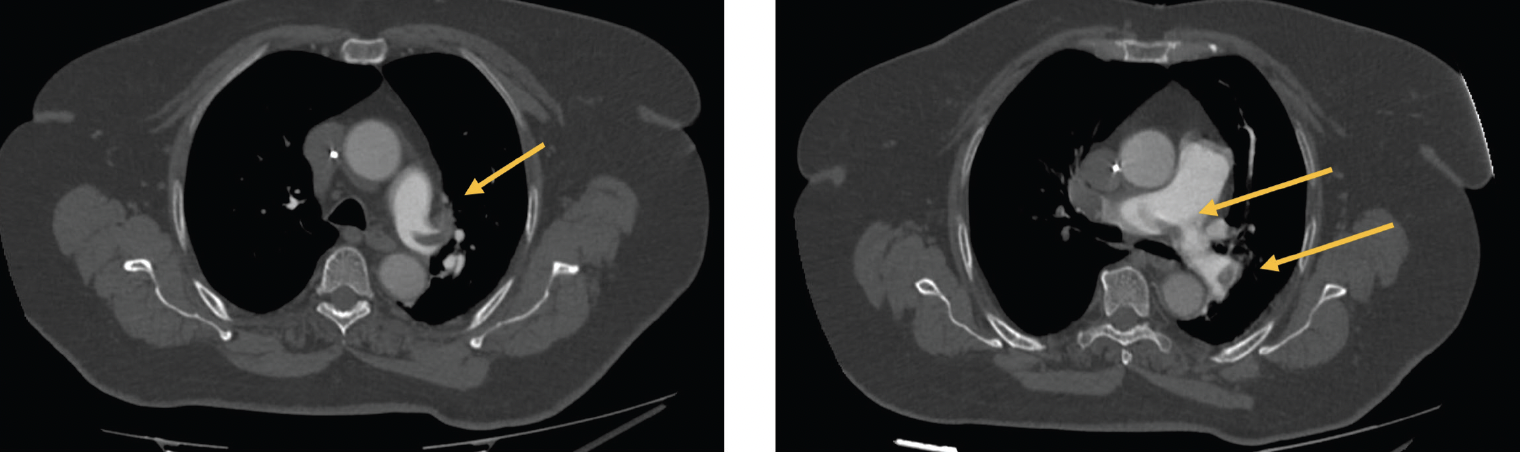 The Akura Thrombectomy Catheter System for the Treatment of VTE ...