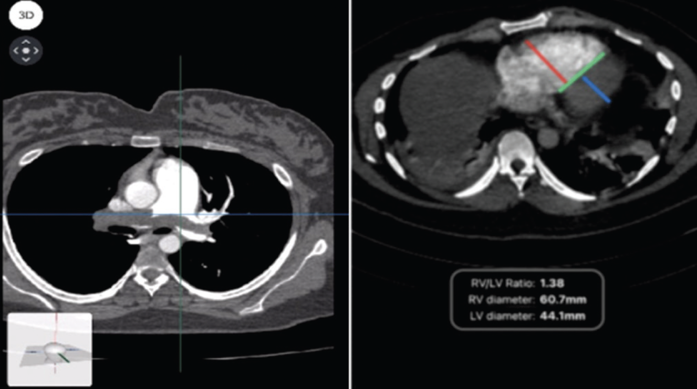 Revolutionizing Pulmonary Embolism Care: The AI Advantage ...