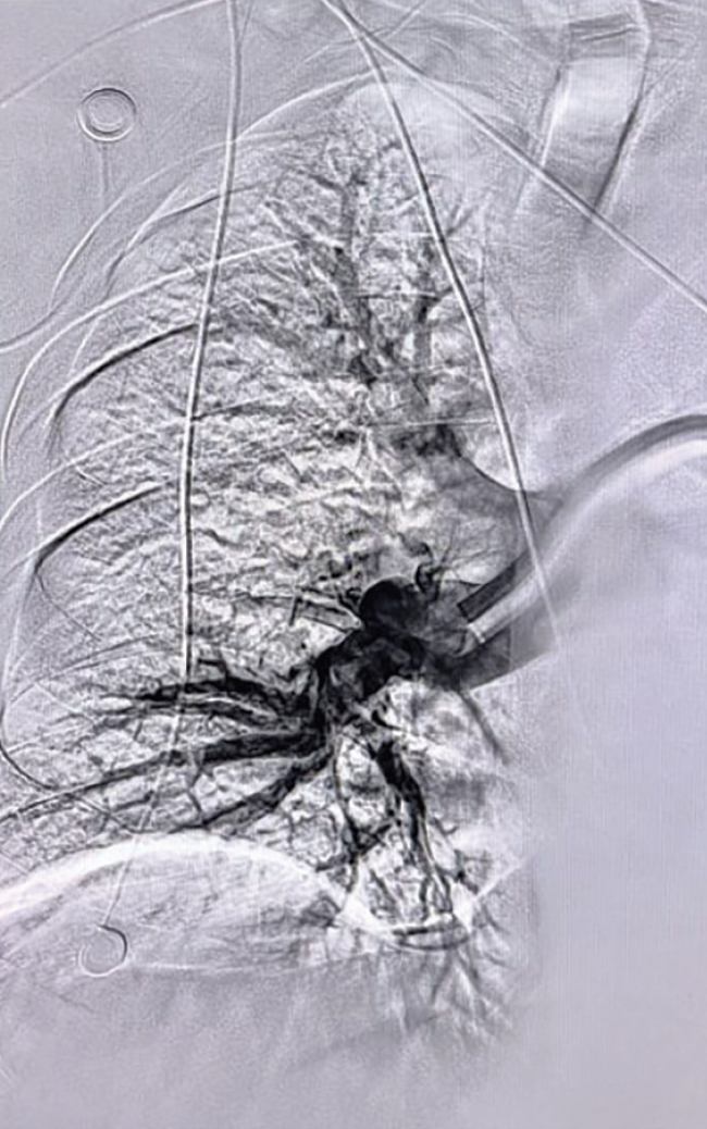 Computer Assisted Vacuum Thrombectomy (CAVT): The Future of Thrombus ...