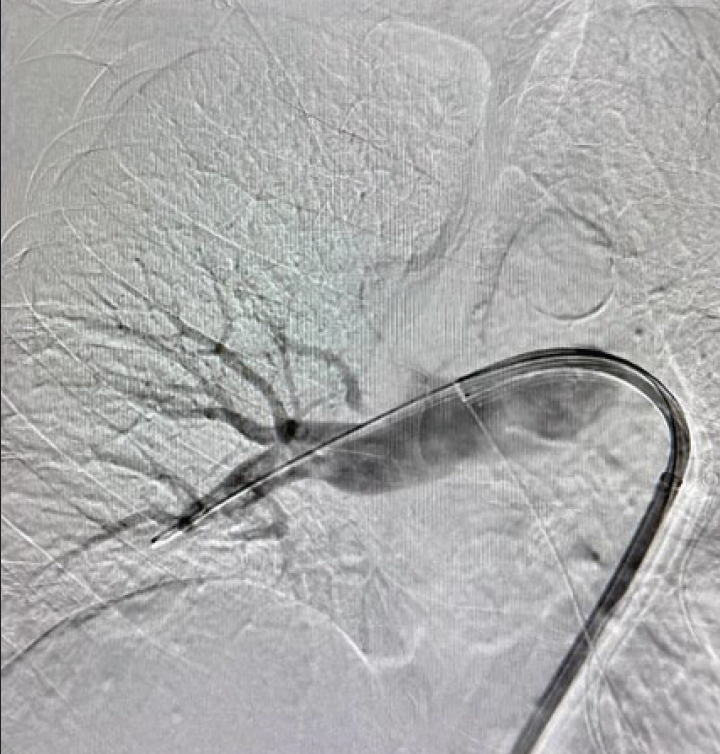 Computer Assisted Vacuum Thrombectomy (CAVT): The Future of Thrombus ...
