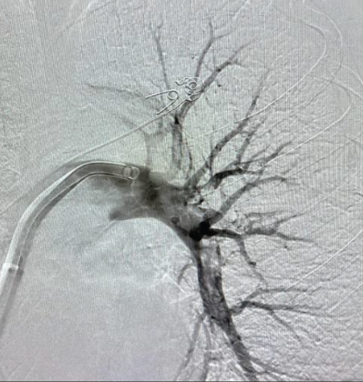 Computer Assisted Vacuum Thrombectomy (CAVT): The Future of Thrombus ...