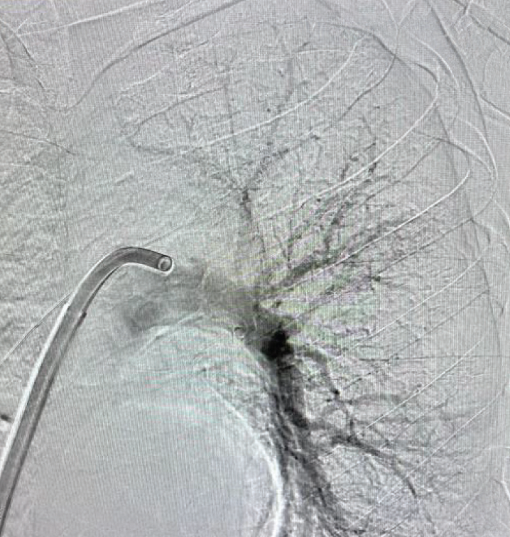Computer Assisted Vacuum Thrombectomy (CAVT): The Future of Thrombus ...