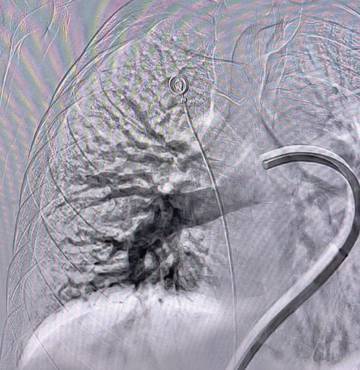 Computer Assisted Vacuum Thrombectomy (CAVT): The Future of Thrombus ...