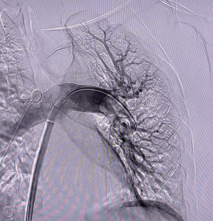 Computer Assisted Vacuum Thrombectomy (CAVT): The Future of Thrombus ...