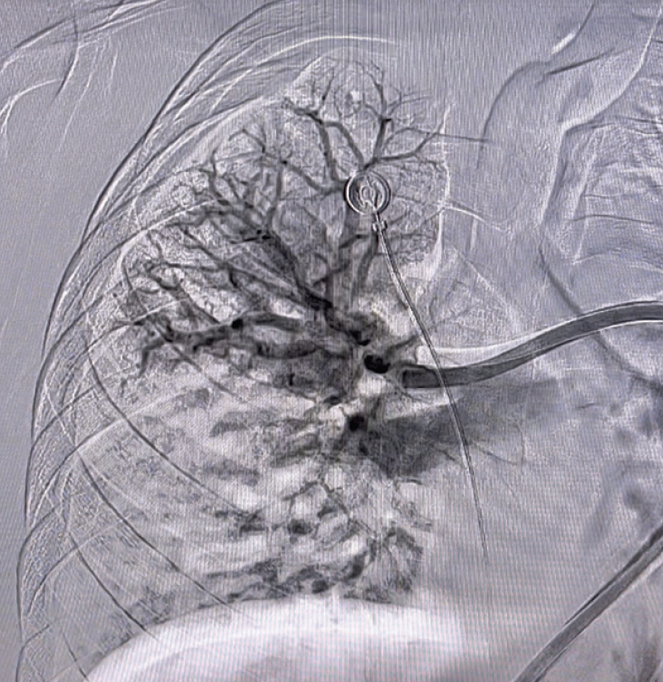 Computer Assisted Vacuum Thrombectomy (CAVT): The Future of Thrombus ...