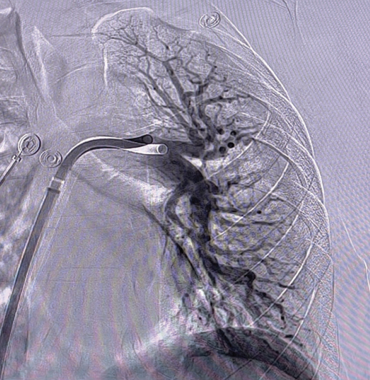 Computer Assisted Vacuum Thrombectomy (CAVT): The Future of Thrombus ...
