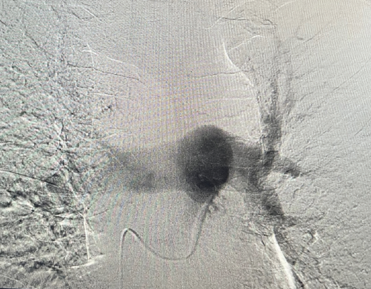 Computer Assisted Vacuum Thrombectomy (CAVT): The Future of Thrombus ...