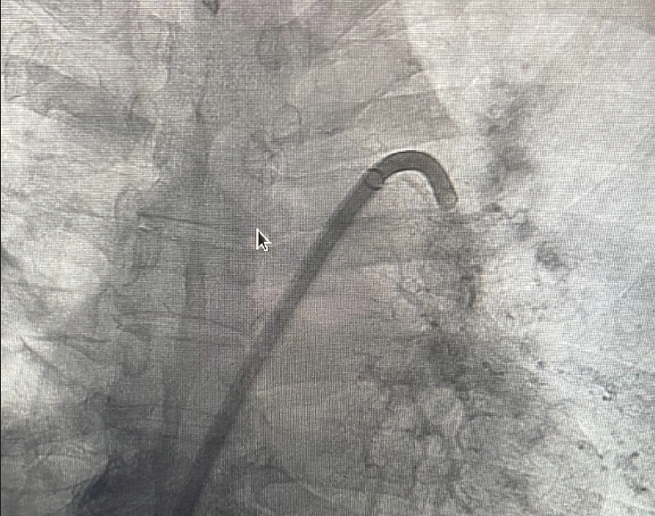 Computer Assisted Vacuum Thrombectomy (CAVT): The Future of Thrombus ...