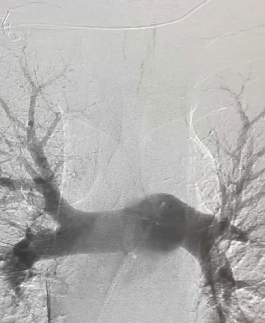 Computer Assisted Vacuum Thrombectomy (CAVT): The Future of Thrombus ...