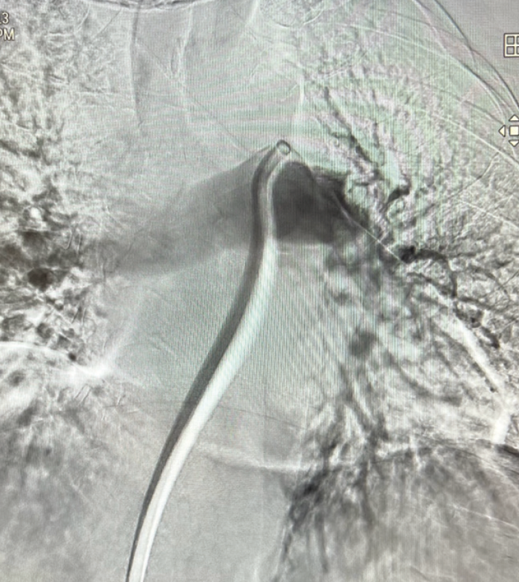 Computer Assisted Vacuum Thrombectomy (CAVT): The Future of Thrombus ...