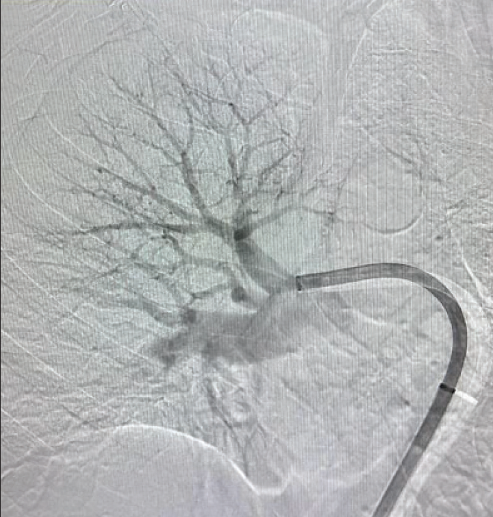 Computer Assisted Vacuum Thrombectomy (CAVT): The Future of Thrombus ...