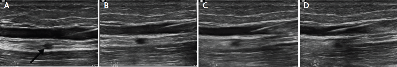 Initial Experiences With the Next-Gen ClosureFast™ 6-Fr Radiofrequency ...