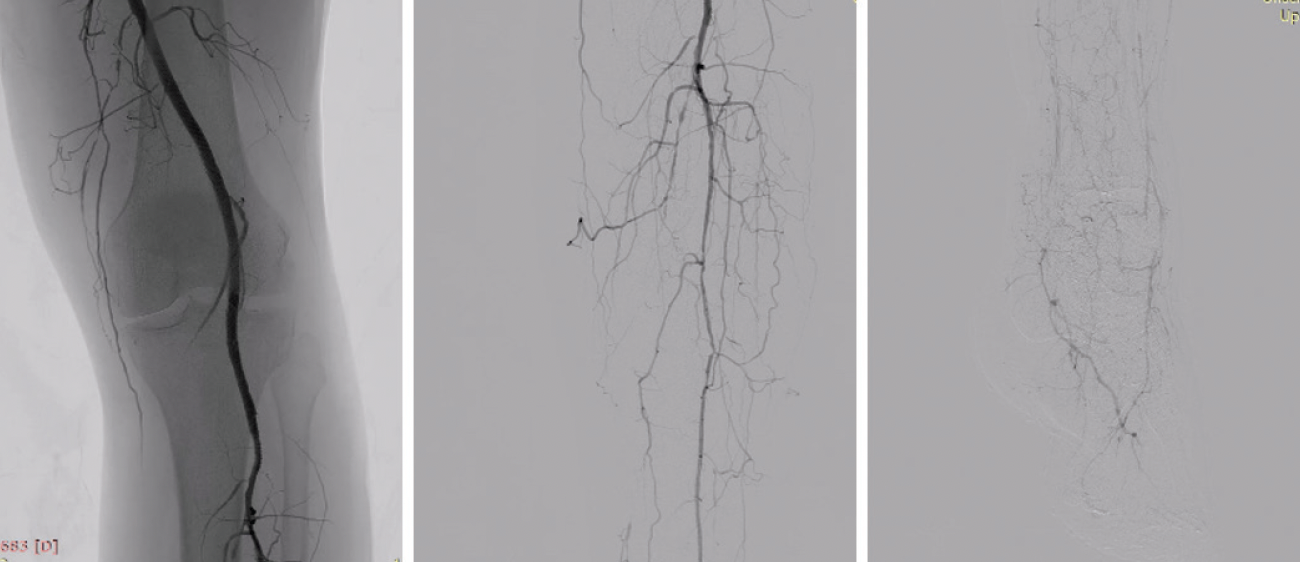 Achieving Success in Calcified SFA and Popliteal Lesions - Endovascular ...