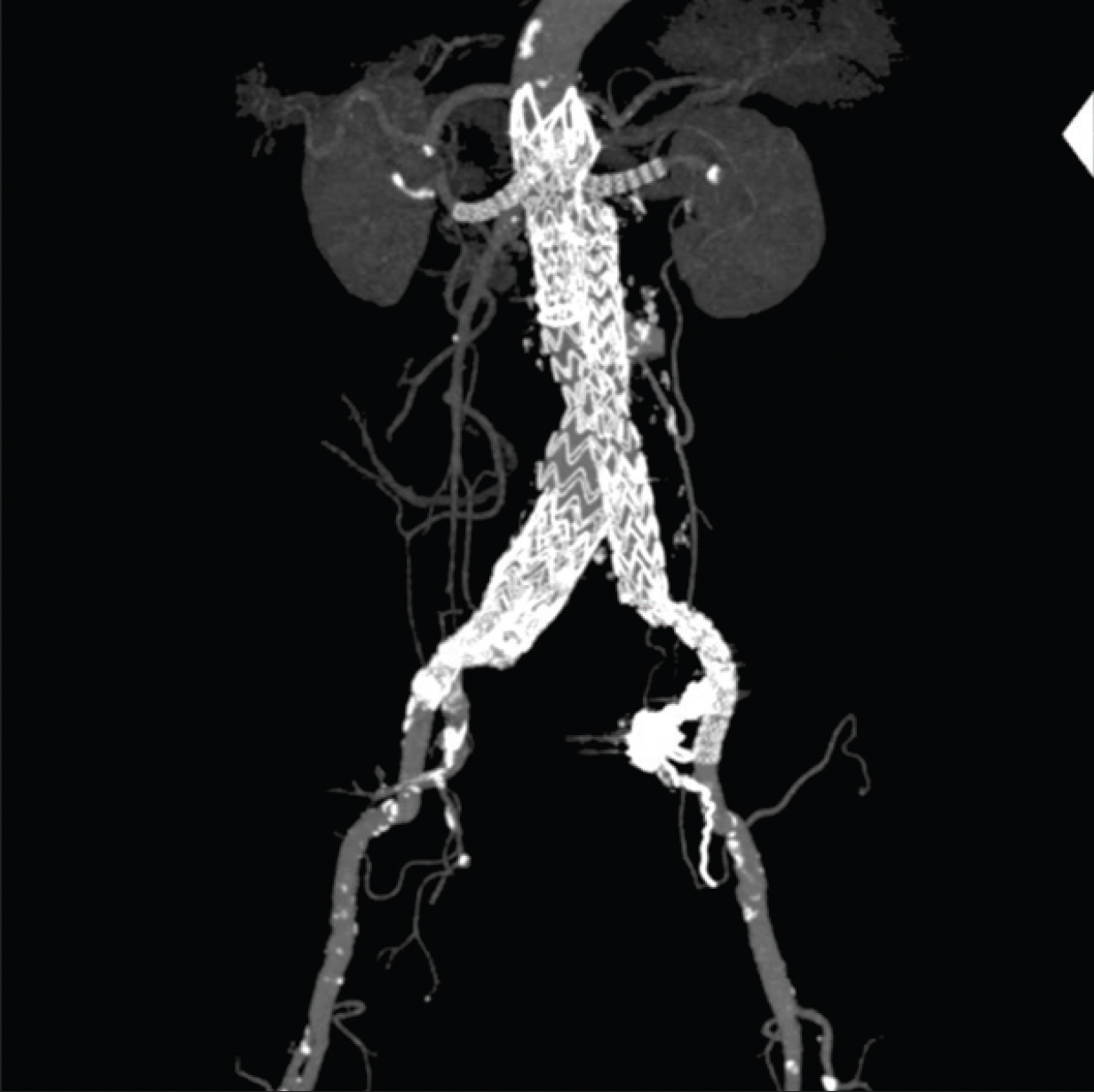 Integrating Shockwave Peripheral IVL Into Our EVAR/TEVAR Practice ...