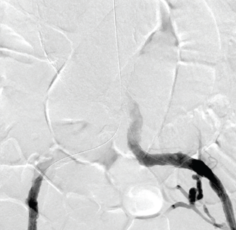 Integrating Shockwave Peripheral IVL Into Our EVAR/TEVAR Practice ...