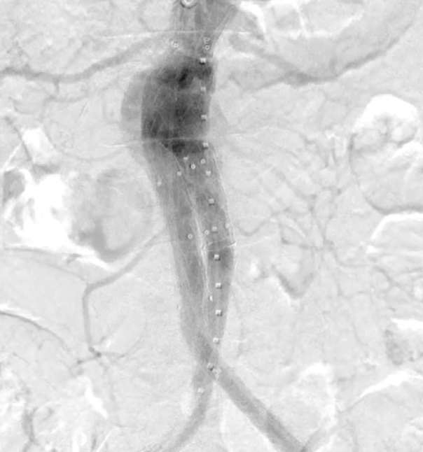 Integrating Shockwave Peripheral IVL Into Our EVAR/TEVAR Practice ...