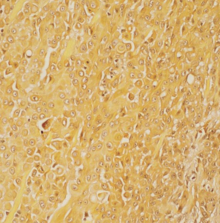 Keratinizing Squamous Cell Carcinoma