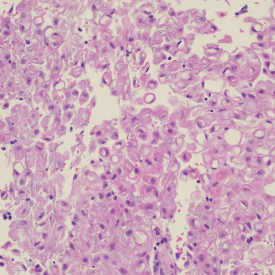 Keratinizing Squamous Cell Carcinoma