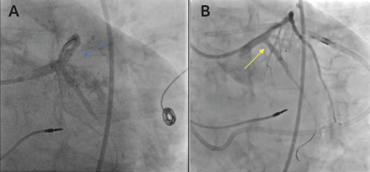 Perforation Management - Cardiac Interventions Today